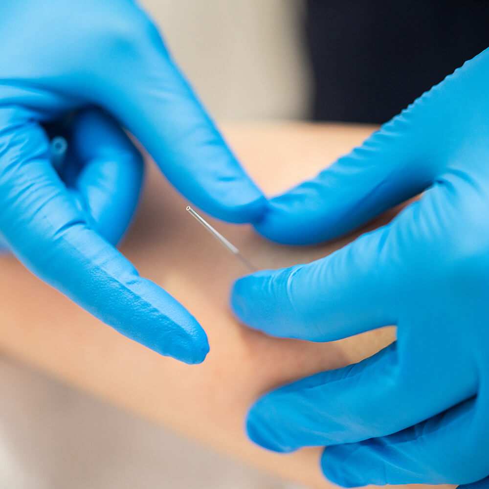 Dry Needling | Physio Cure